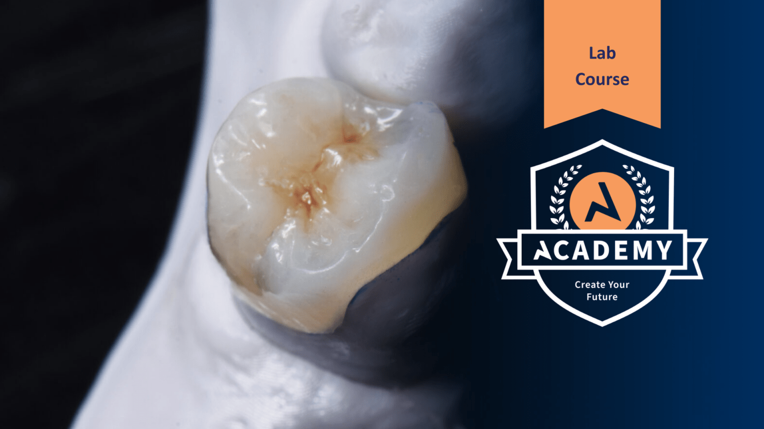 TWiNY Composite Onlay with Effects - ALS Dental