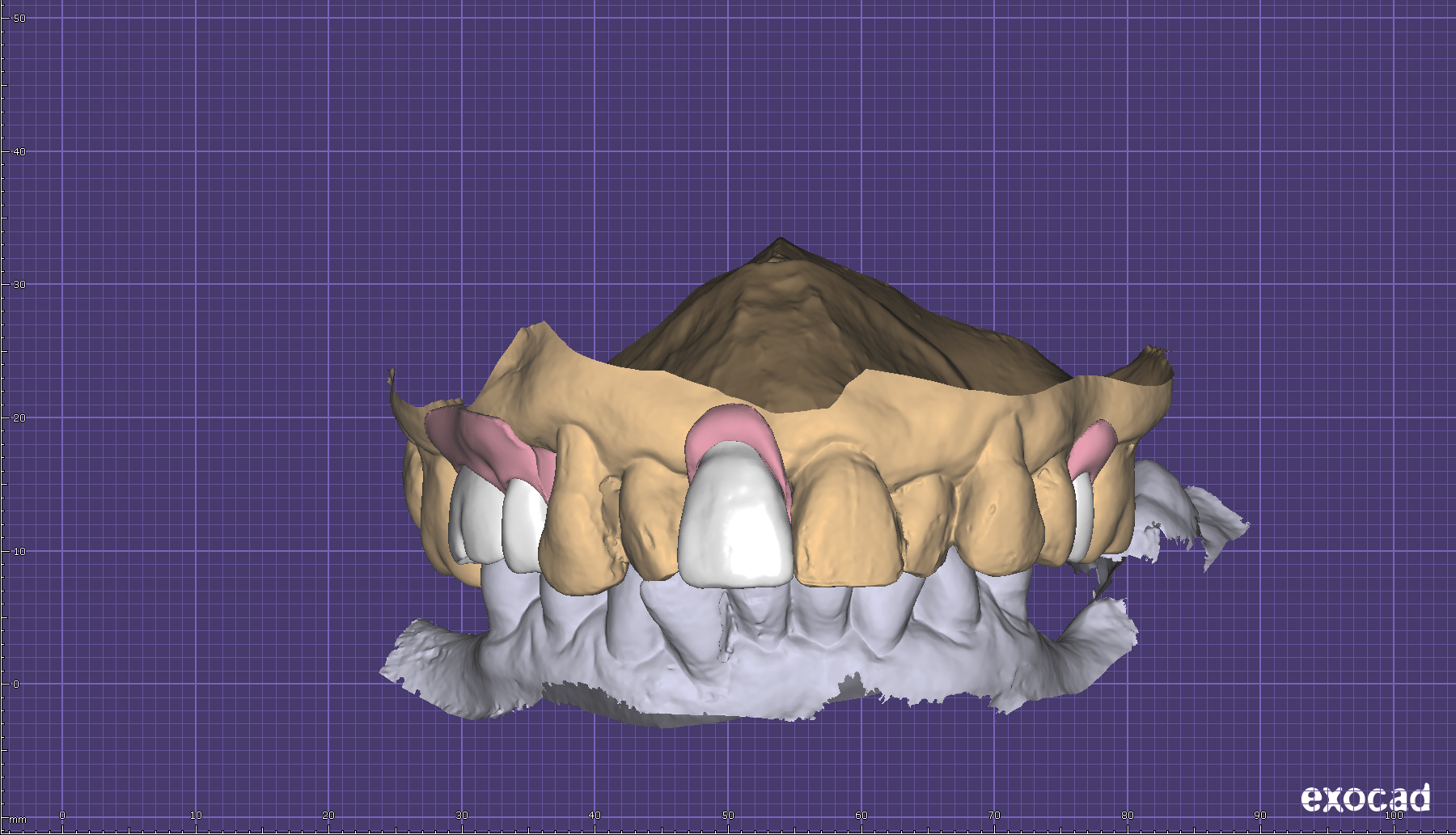 Dentuvo®Digital Dentures Discovery Evening Exeter - ALS Dental