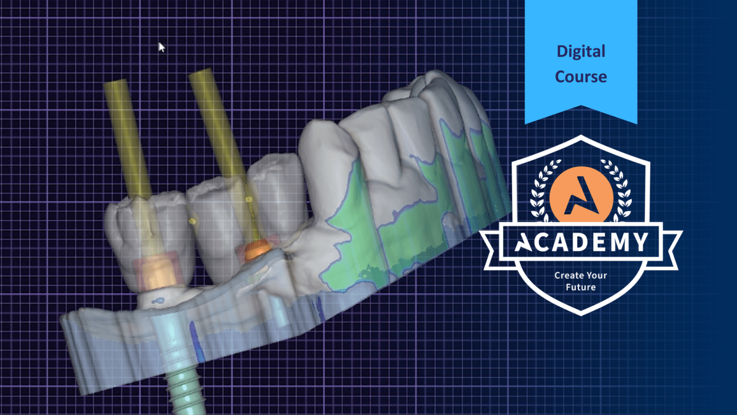 Exocad 3 Unit Implant Bridge (posterior) - ALS Dental