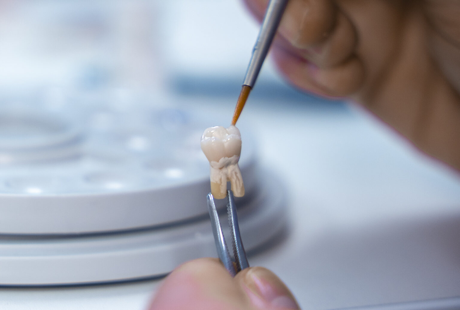 Kiori Zirconia Crown Advantages over Porcelain Bonded Crowns - ALS Dental