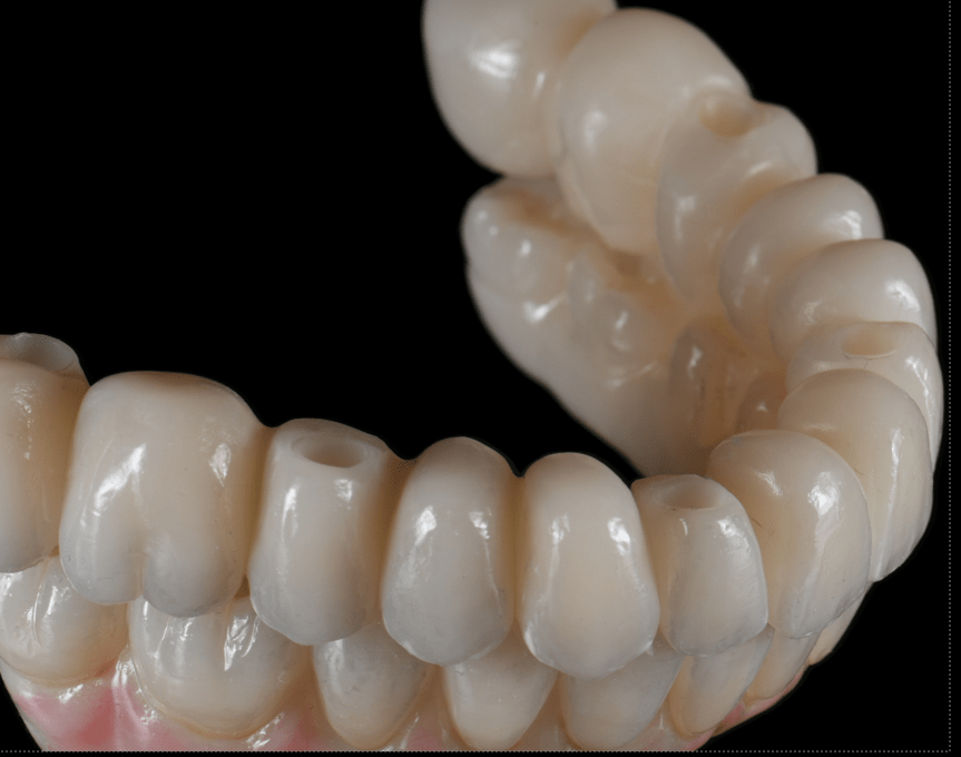 Evolution Of Full Arch Cases With Photogrammetry- Webinar 20th Feb ...