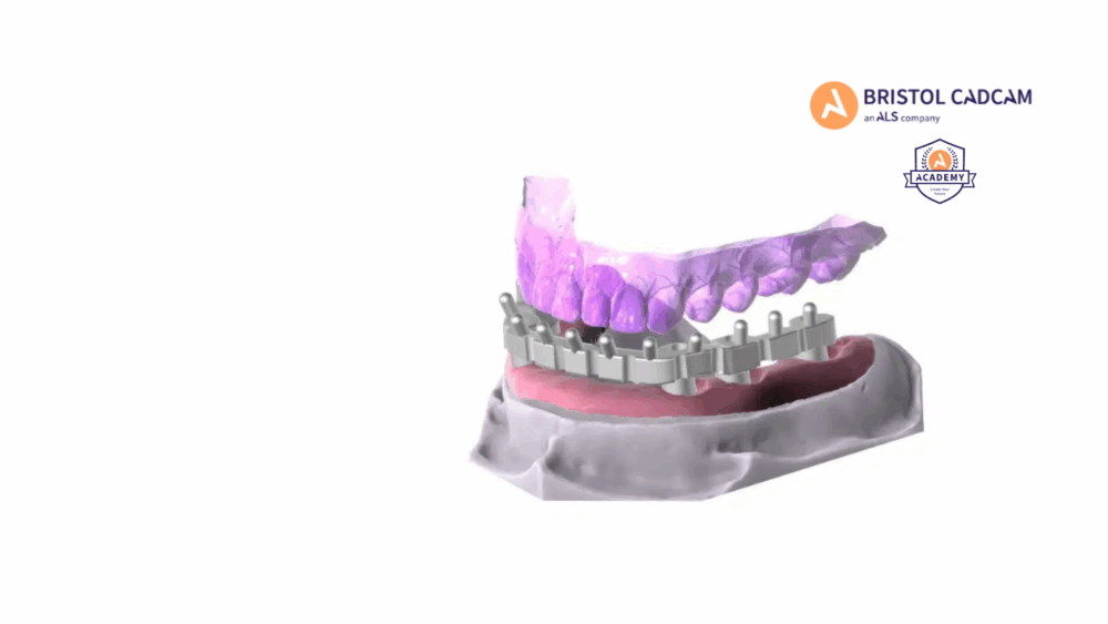 L3- Exocad Advanced- Full Arch Bar Design (10th July) - ALS Dental