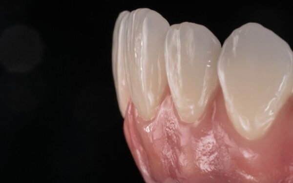 IPS e.max Ceram Art: Stain & Glaze System - ALS Dental